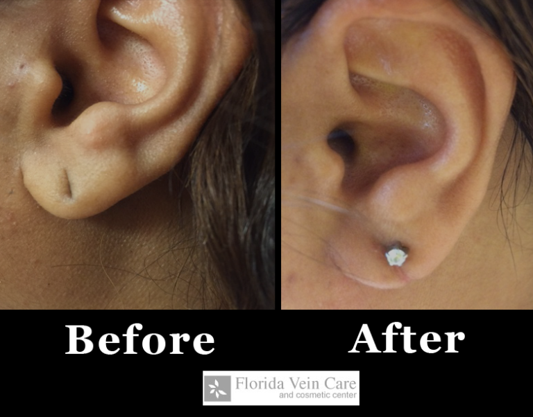 Before and After Spider Vein Treatments in Orlando